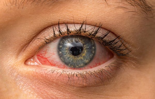 Understanding Dry Eye: Causes, Symptoms, and Treatment Options %sep ...