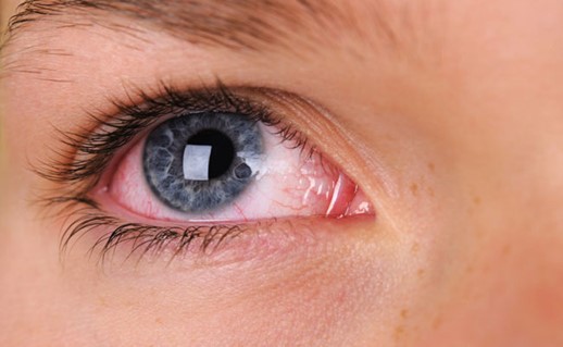 Dry Eye Syndrome: Causes, Symptoms, and Treatments