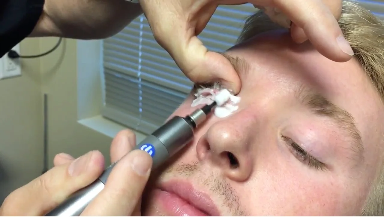 Effective Treatment of Blepharitis with BlephEx | European Eye Center