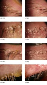 BlephEx treatment for blepharitis | European Eye Center